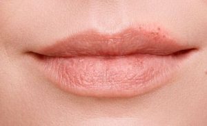 Cold Sore Stages (with Pictures) - The 5 Stages of Cold Sore Outbreak